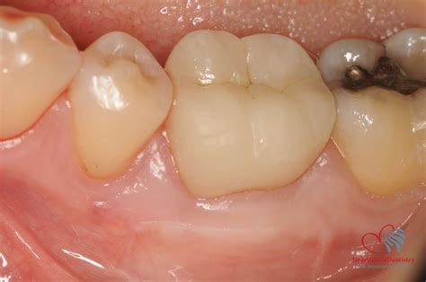 Guided Apicectomy According To The Technique G Carrieri P Villa M