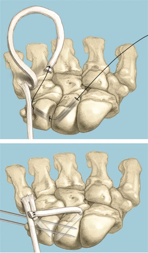 Extensor Carpi Ulnaris Tenodesis Thomas R Hunt Iii M D D Sc