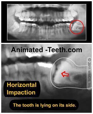 What Are Impacted Wisdom Teeth Types Of Impactions Classifications