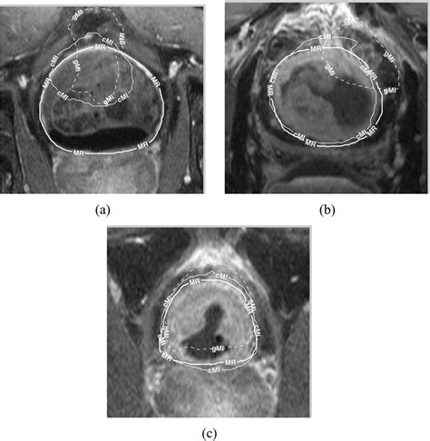 some rectum delineations obtained using gmi and cmi based image