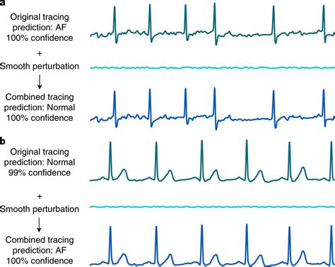 Ecg Tracings And Interpretation Online Discounts Villadellequerceit