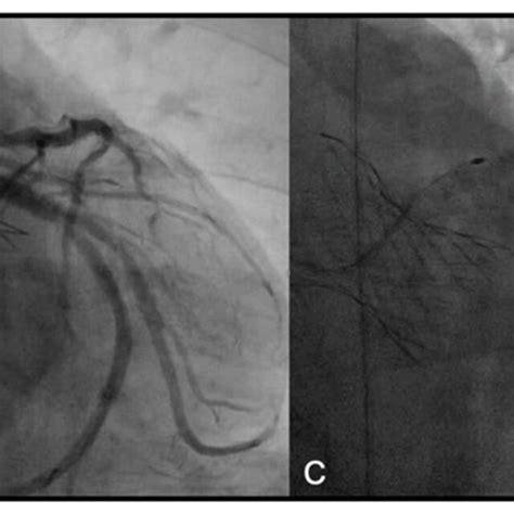Rotational Atherectomy Ra Following Medtronic Corevalve Deployment By
