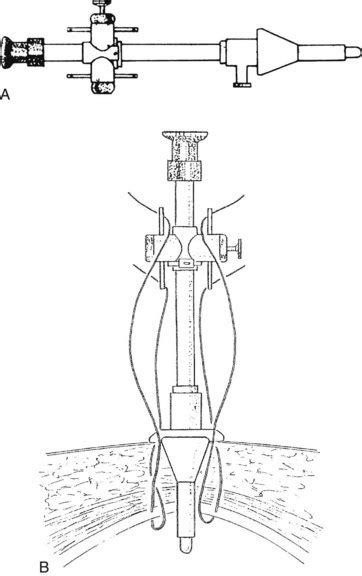 Laparoscopic Cholecystectomy And Choledocholithotomy Abdominal Key