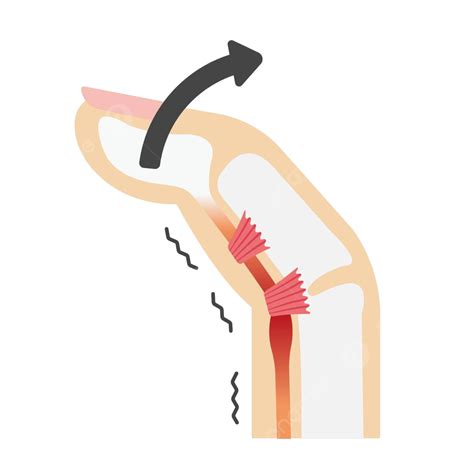 Trigger Finger Causes And Symptoms Illustration Finger People Hospital