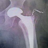 A Preoperative X Ray AP And Lateral View B Immediate Postoperative
