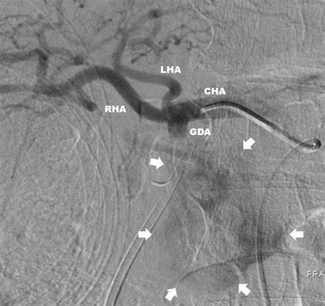 Gastroduodenal Artery Pseudoaneurysm Causing Obstructive Jaundice