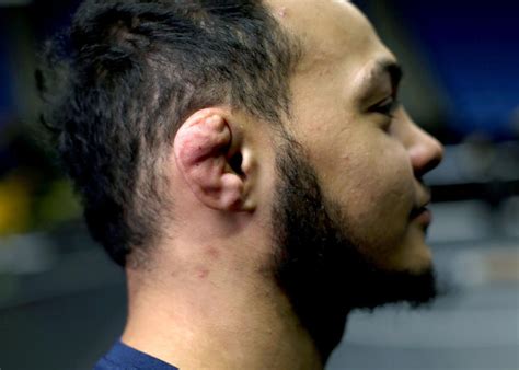 Cauliflower Ear What Causes It At Diane Rearick Blog