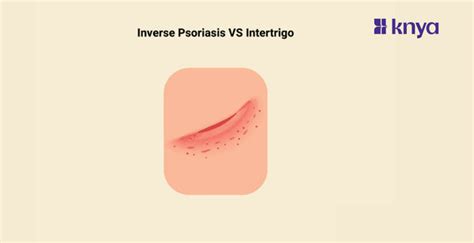 Inverse Psoriasis Vs Intertrigo Learn The Features Of Each Of Them Knya