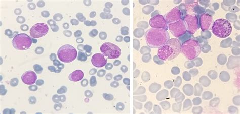 Abnormal Eosinophils In The Bone Marrow Aspirates Of A Patient With Aml