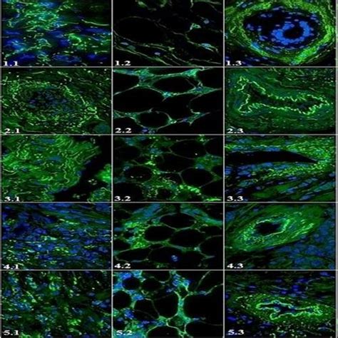 Protein Expression Of Cxcr 4 Receptors In Peritumoral Column Ii And