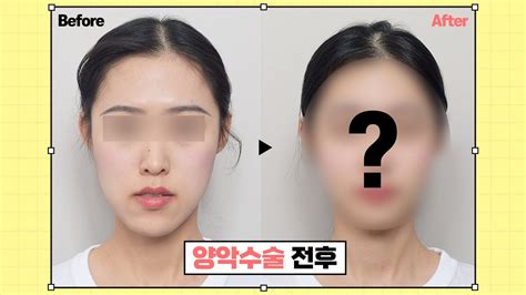 양악수술and브이라인수술 2년 차까지 비교 Youtube