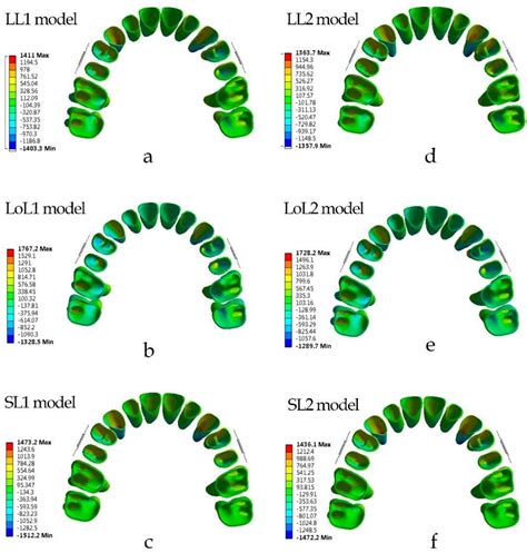 Figure 7 From Stress Distribution And Tooth Displacement Analysis Of Maxillary Molar