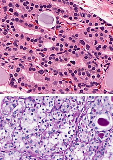 Dyshormonogenetic Goiter Top This Thyroid Is From A Thyroidectomy