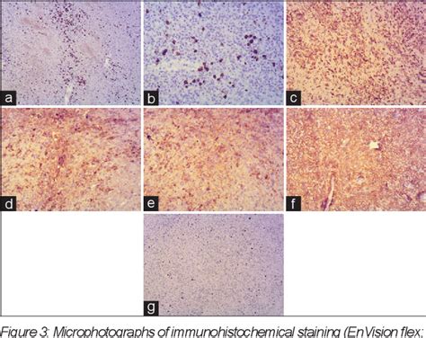 Figure 3 From Inflammatory Pseudotumorinflammatory Myofibroblastic
