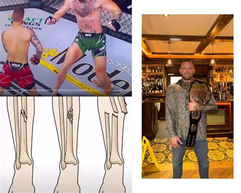 What Fight Did Connor Mcgregor Break His Leg
