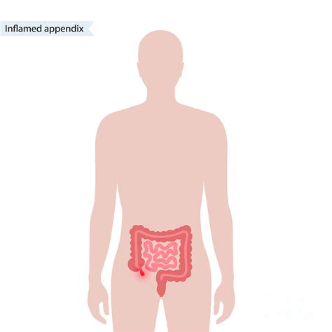 Inflamed Appendix Photograph By Pikovit Science Photo Library Pixels