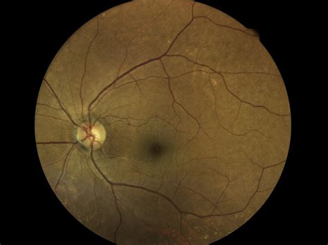 Case 61 Range Of Retinoschisis Revisited Page 24 Of 47 Retina