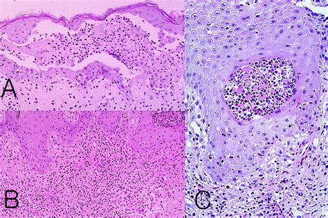 Pyodermatitis Pyostomatitis Vegetans With Circulating Autoantibodies To Bullous Pemphigoid