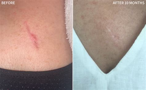 Before And After Skincare Photo Gallery Rescuemd Tagged Scar