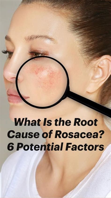 Rosacea Skincare Tips Artofit