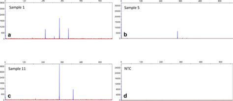Ad Genescan Based Fragment Length Analysis Of Flt3 Itd Mutation Was
