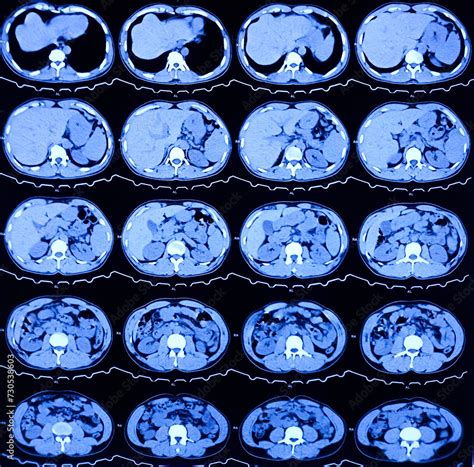 Ct Scan Of Hbs And Pancreas Contrast Solitary Non Enhancing