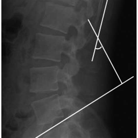 Lateral Plain Radiograph Of The Lumbar Spine Showing Cobbs Method