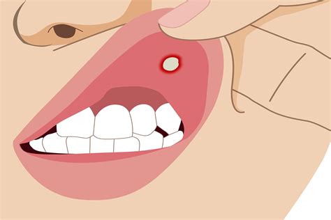 Aphte Im Mund Ursachen Symptome Und Effektive Behandlung