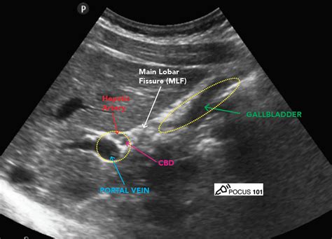 Main Lobar Fissure Ultrasound