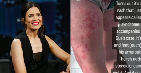 Mandy Moores Son Gus Has Rare Skin Condition Called Gianotti Crosti