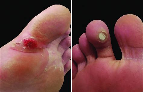 A Pinpoint Bleeding After Needling With 5 5 Fu B Frosting After