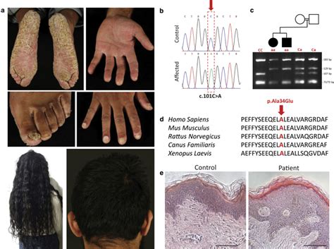 Recessive Mutation In Fam83g Associated With Palmoplantar Keratoderma And Exuberant Scalp Hair Recessive Mutation In Fam83g Associated With Palmoplantar Keratoderma And Exuberant Scalp Hair