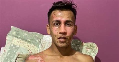 Estremecedoras Imágenes De Un Juvenil De Vélez Que Se Quemó Con Aceite