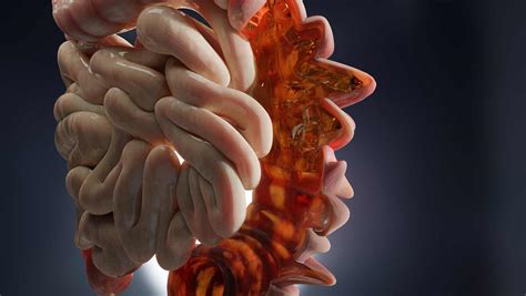Understanding What Is Diverticulitis Know The Facts