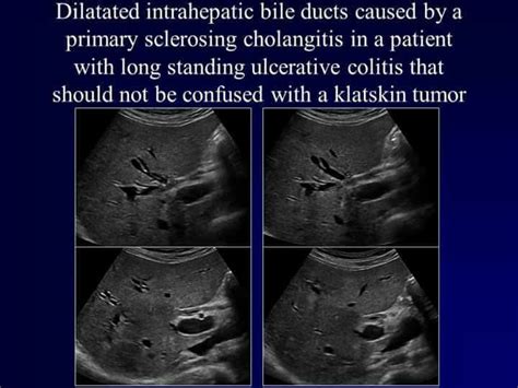 Cholangitis Ultrasound