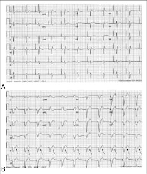 Pacemaker Syndrome Due To Pacing Mode Change At Pacemaker Battery Download Scientific Diagram