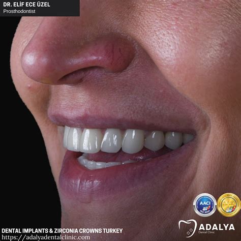 Dental Implant Clinics In Turkey Pjhe