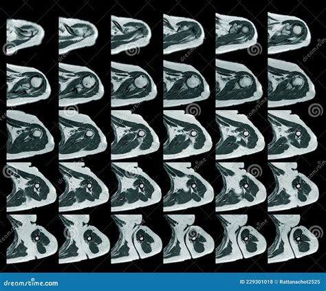 Magnetic Resonance Imaging Of Left Shoulder Rotator Cuff Tear With