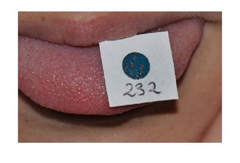 Quantifying Funorm Papillae Density Location Of The 6 Mm Area For Download Scientific