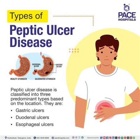 Peptic Ulcer Disease Treatment For Peptic Stomach Ulcers Signs