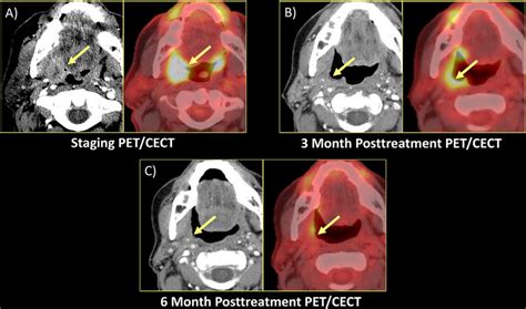 Tonsil Cancer Staging