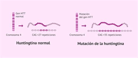 ¿en Qué Consiste La Enfermedad De Huntington ¿se Previene Con Dgp