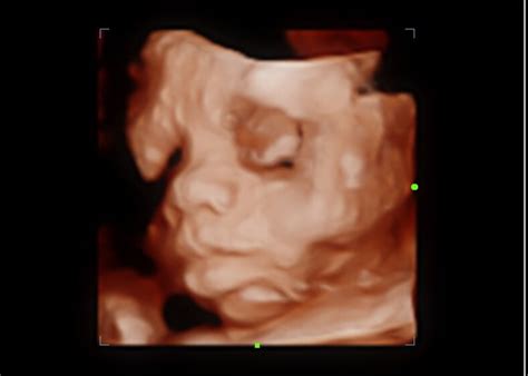 Cleft Lip 15 Week Ultrasound