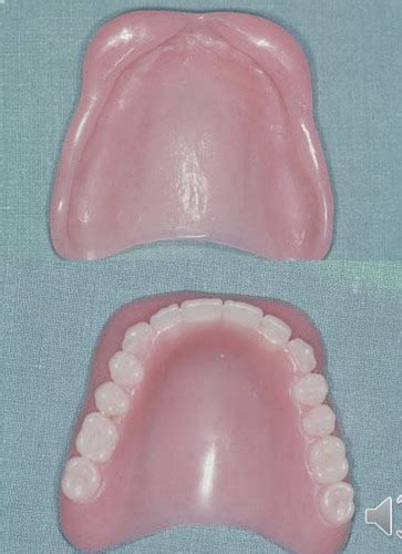 Complete Denture Trial Assessment Flashcards Quizlet