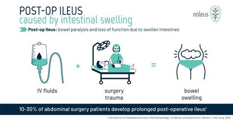 🦸‍♀️ Swarna Balasubramaniam Md On Linkedin What Causes Post Op Ileus