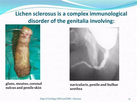 Penis Balanitis Xerotica Oblitaransbxo Pdf