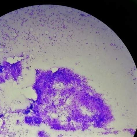 Fnac Lymph Node Cytological Study H E Stain Revealing Chronic