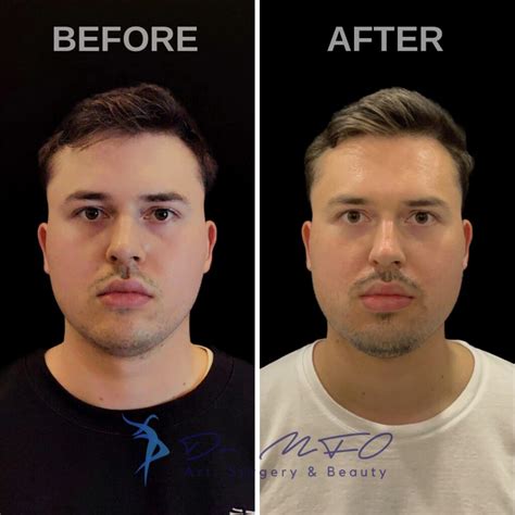 Facial Masculinization Surgery Dr Mfo Ffs Surgeon In Turkey