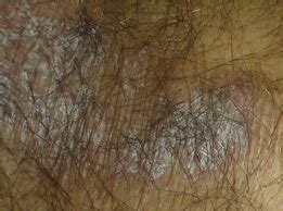 Scalp Inflammation And Hair Loss Hair Restoration News Worldwide