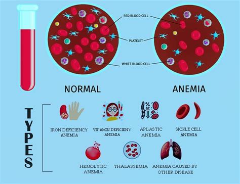 A Guide To Bone Marrow Transplants For Anemia In India